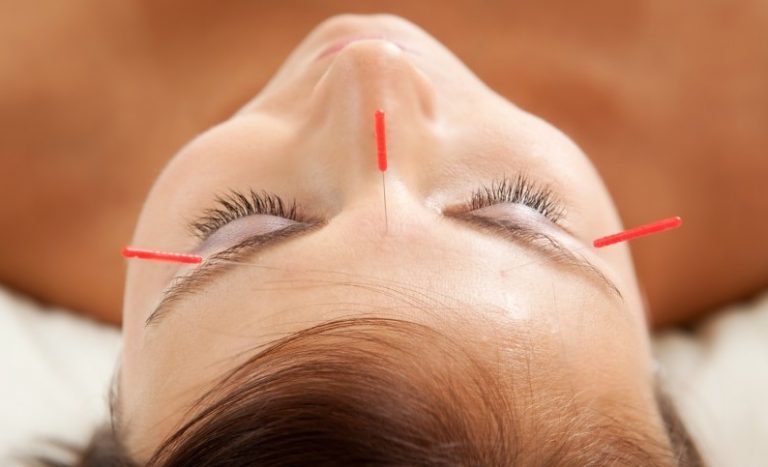 Facial Acupuncture for Wrinkles Benefits, Effectiveness, and Risks